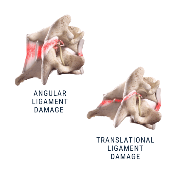 Spinal Support Ligament Injury 101